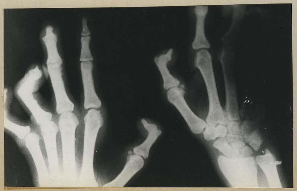 6 Strange Facts About Leprosy | Live Science