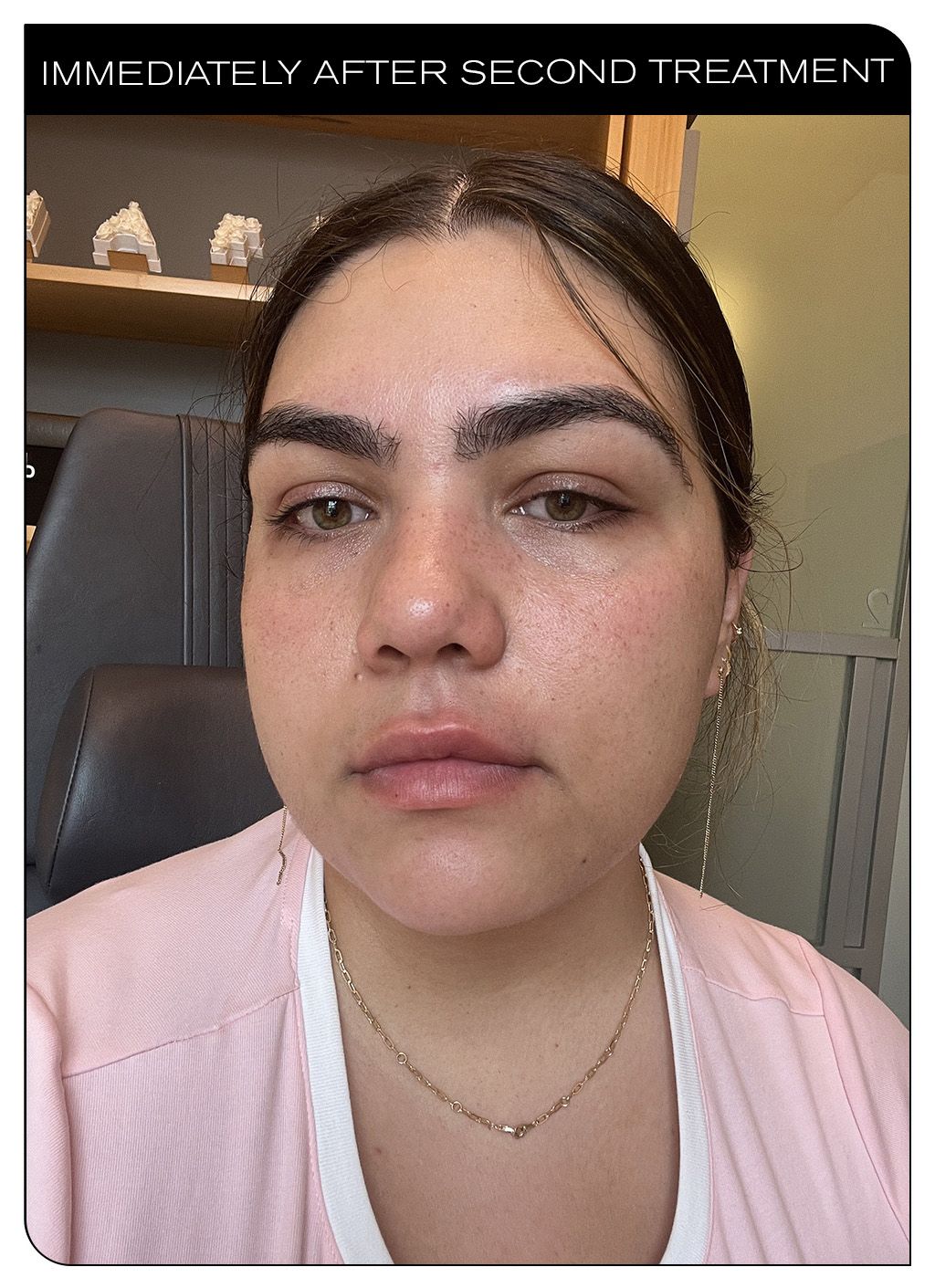 Lip Filler Dissolver: What It Is and What to Expect | Who What Wear