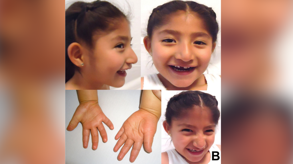 Angelman syndrome: A disorder that stops people walking and speaking ...