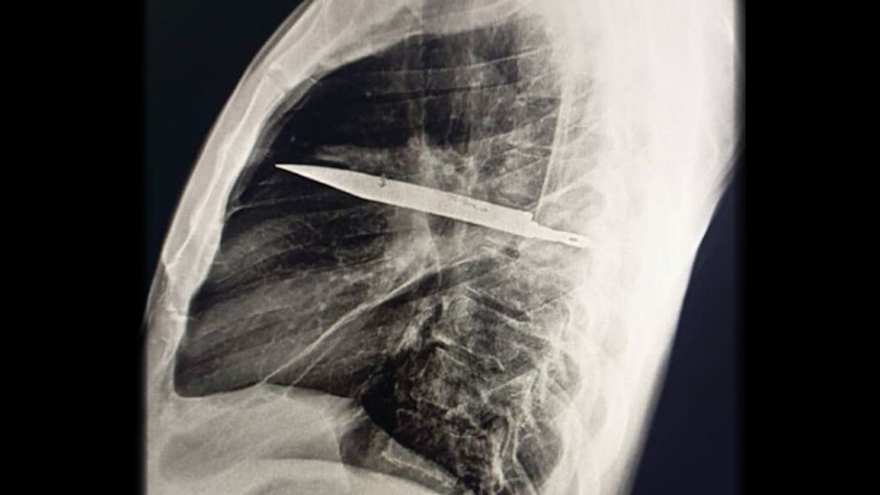 Diagnostic dilemma: A knife broke off in a man's chest, and he didn't ...