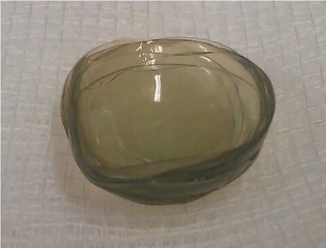 Doctors Discover 27 Contact Lenses in Woman's Eye | Live Science