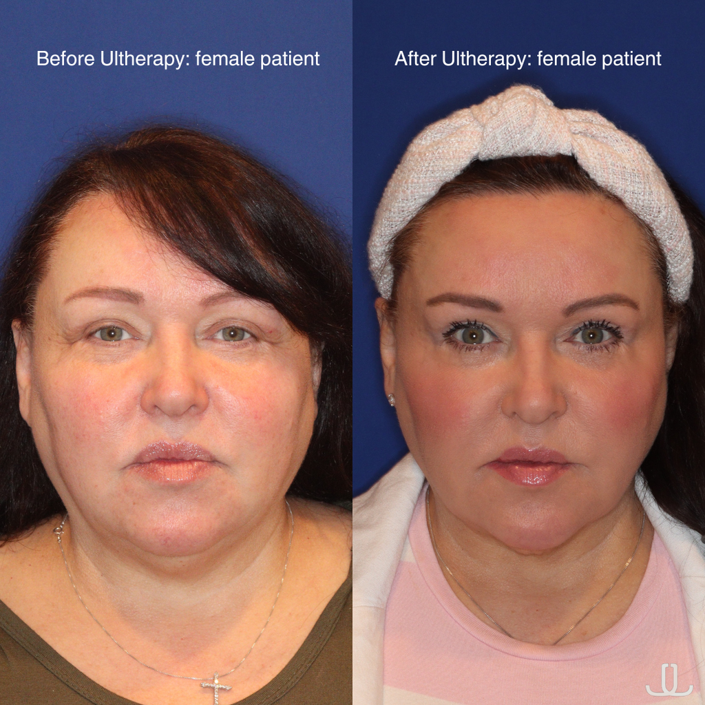 Everything to Know About Ultherapy: Benefits, Cost, and More | Who What ...