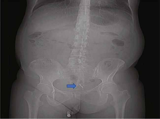 Woman's IUD 'eroded' through her uterus and punctured her bladder ...