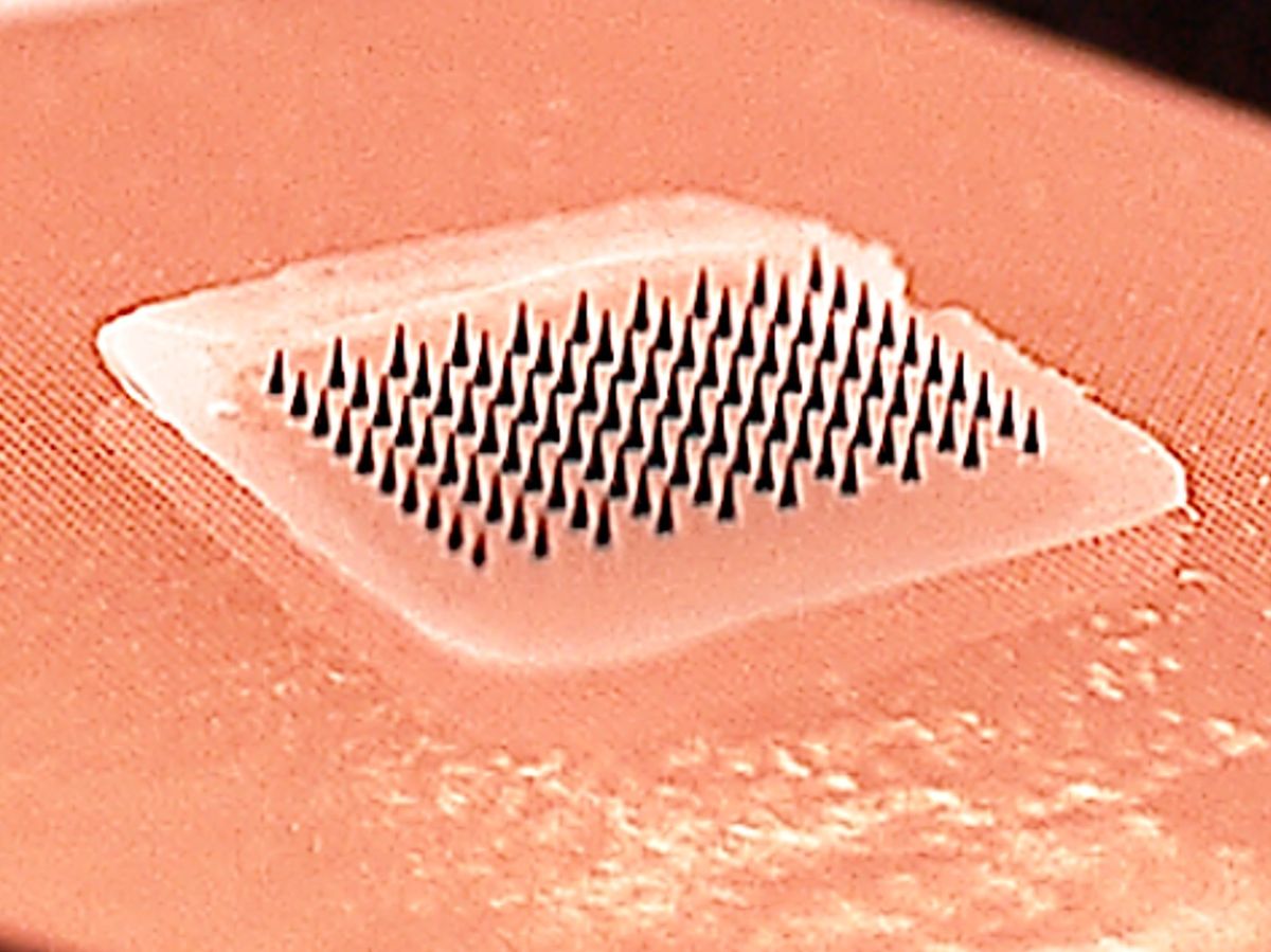 Photos: How 'Microneedles' Can Deliver the Flu Vaccine | Live Science