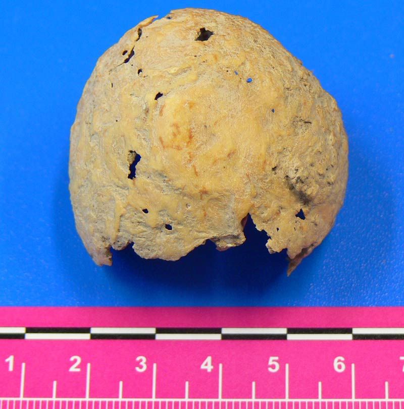 Image Gallery: Ancient Corpse Reveals Medical Oddity | Live Science