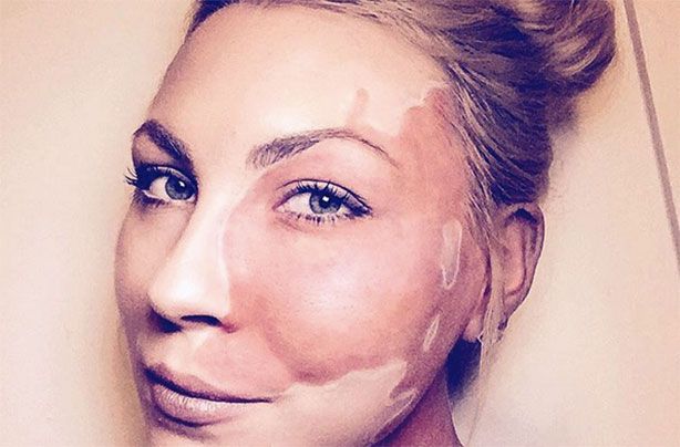 Model covers birthmark with glitter to embrace her 'imperfections' and ...