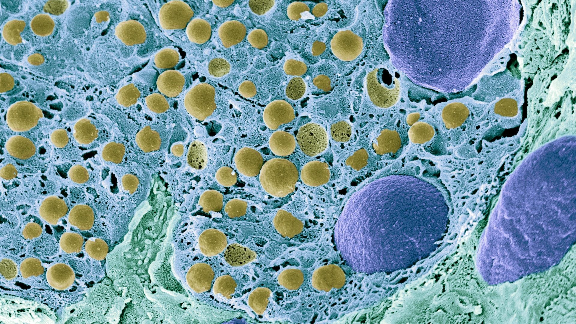 In a 1st, scientists reversed type 1 diabetes by reprogramming a person ...