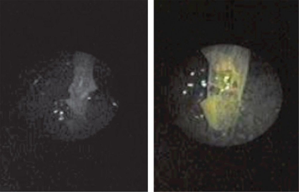 Oops! Brain-Removal Tool Left in Mummy's Skull | Live Science