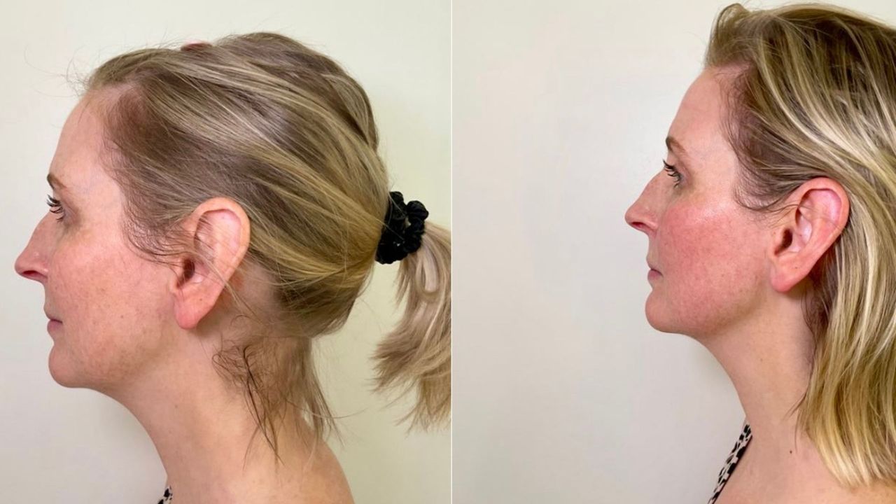 Our Emface review (including before and after pictures) | Woman & Home