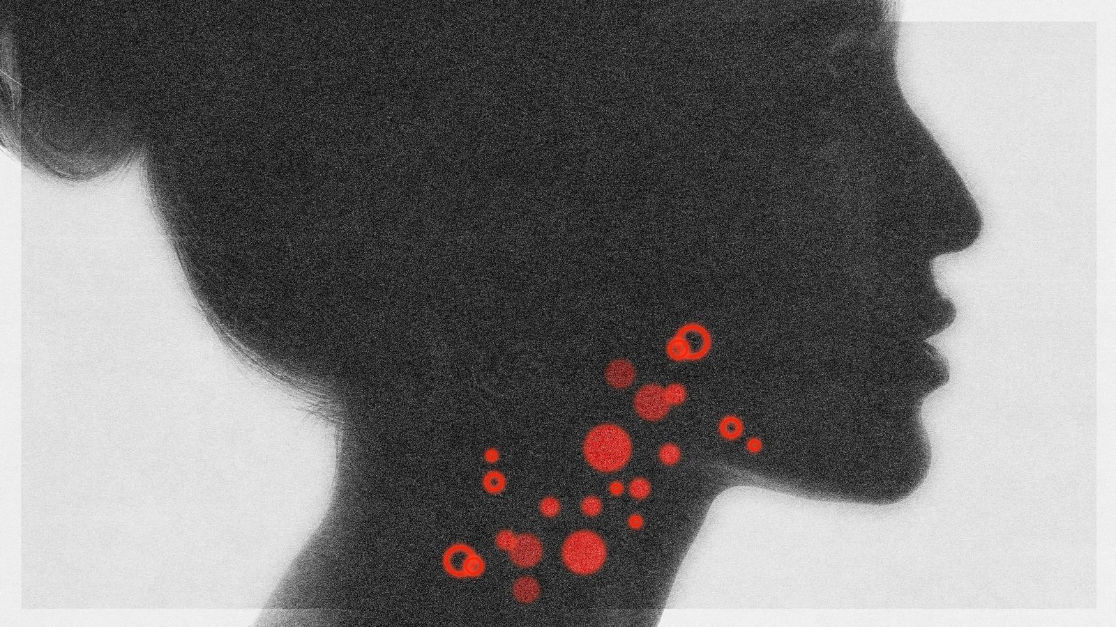 How to Prevent and Treat Monkeypox Scarring | Marie Claire