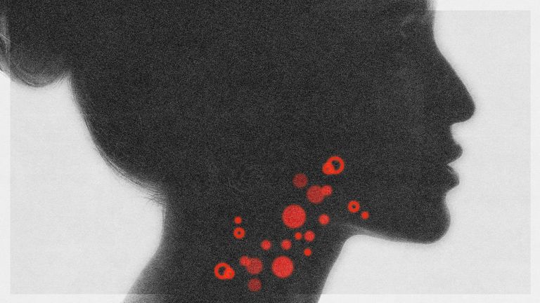 How to Prevent and Treat Monkeypox Scarring | Marie Claire