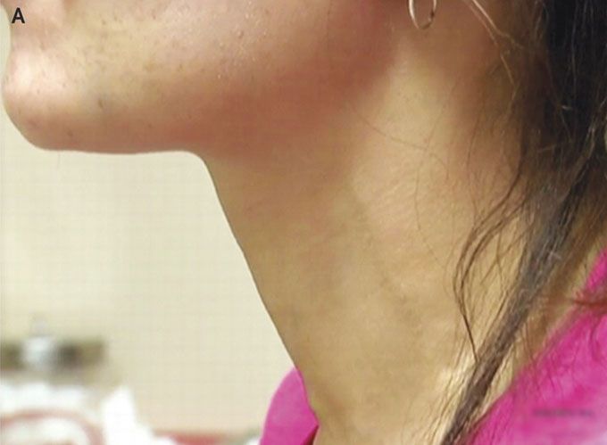 Woman's Pulse Surges Through Her Neck, Reveals Heart Condition | Live ...