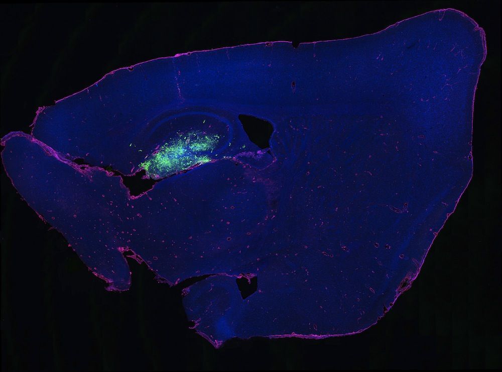 Colorful But Deadly: Images of Brain Cancer | Live Science