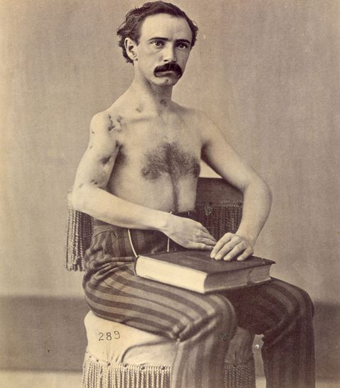 Album: Faces and Injuries of the Civil War | Live Science