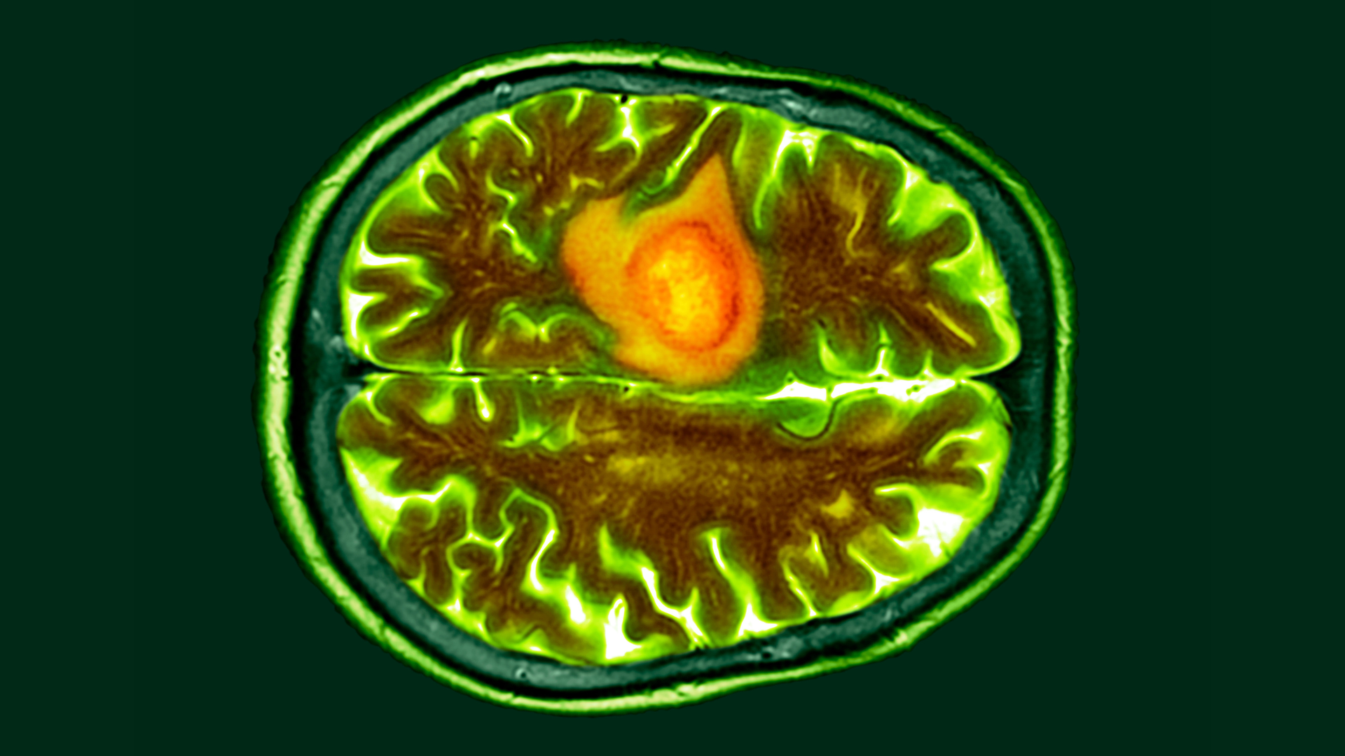 Designer immune-cell therapy could shrink deadly brain tumors, early ...