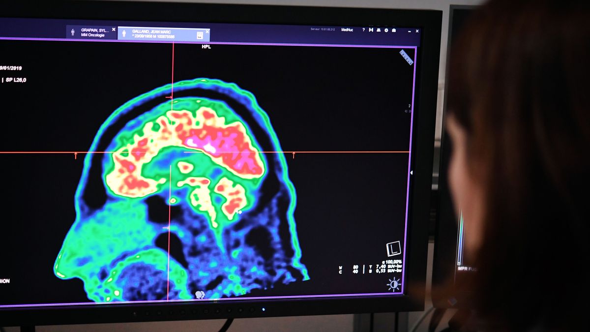 Lasting impact: how Covid damages the human brain | The Week