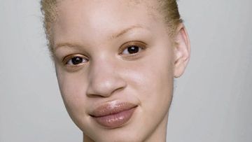 albino black person - Kenosha Robinson - people with albinism | Marie ...