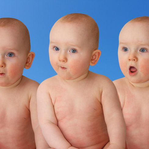 Quadruplets Conjoined Triplets