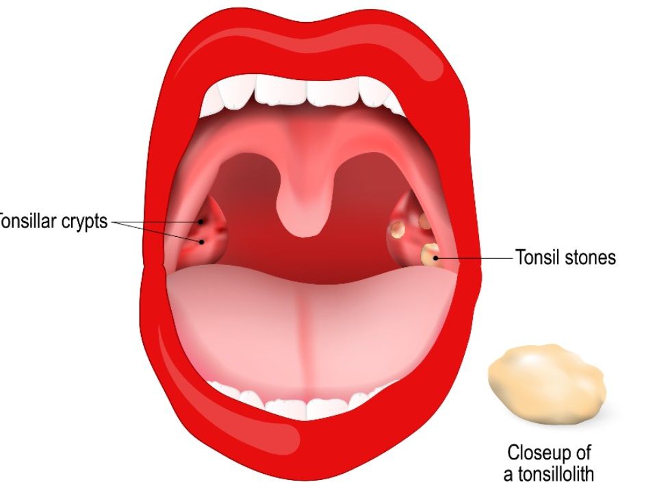 Tonsil Crypts Stones