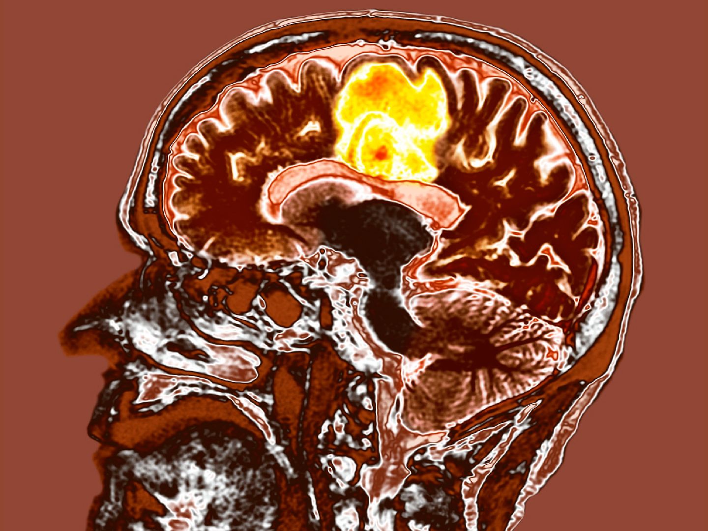 Brain Cancer