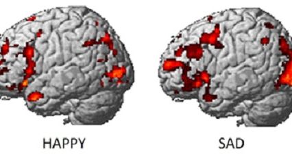 Anger Brain Scan Improving Epilepsy Surgery: New Research Reveals How
