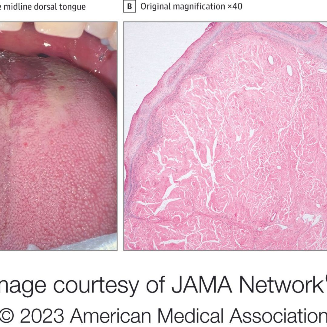 Median Rhomboid Glossitis Diagnosis