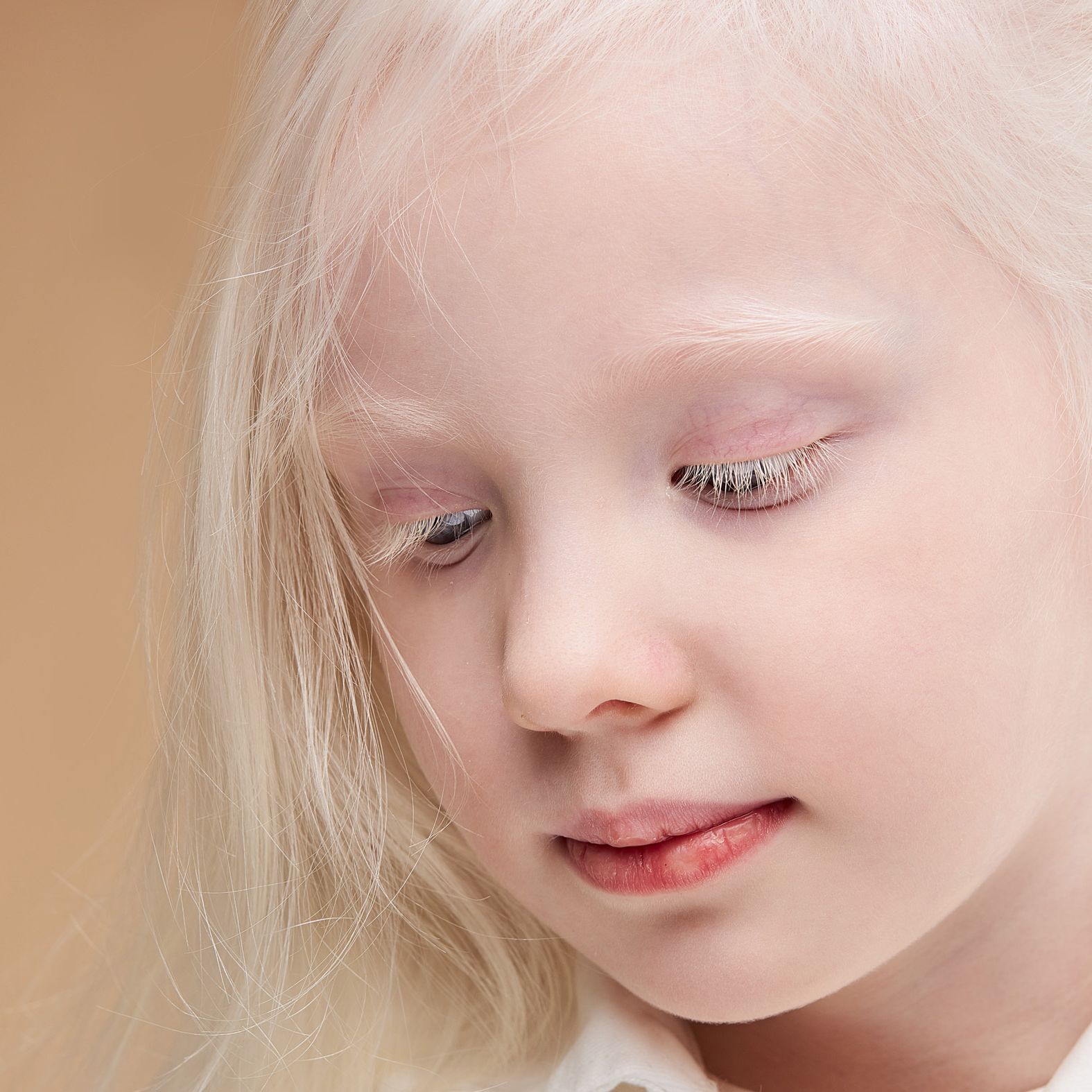 Albinism In Humans Eyes