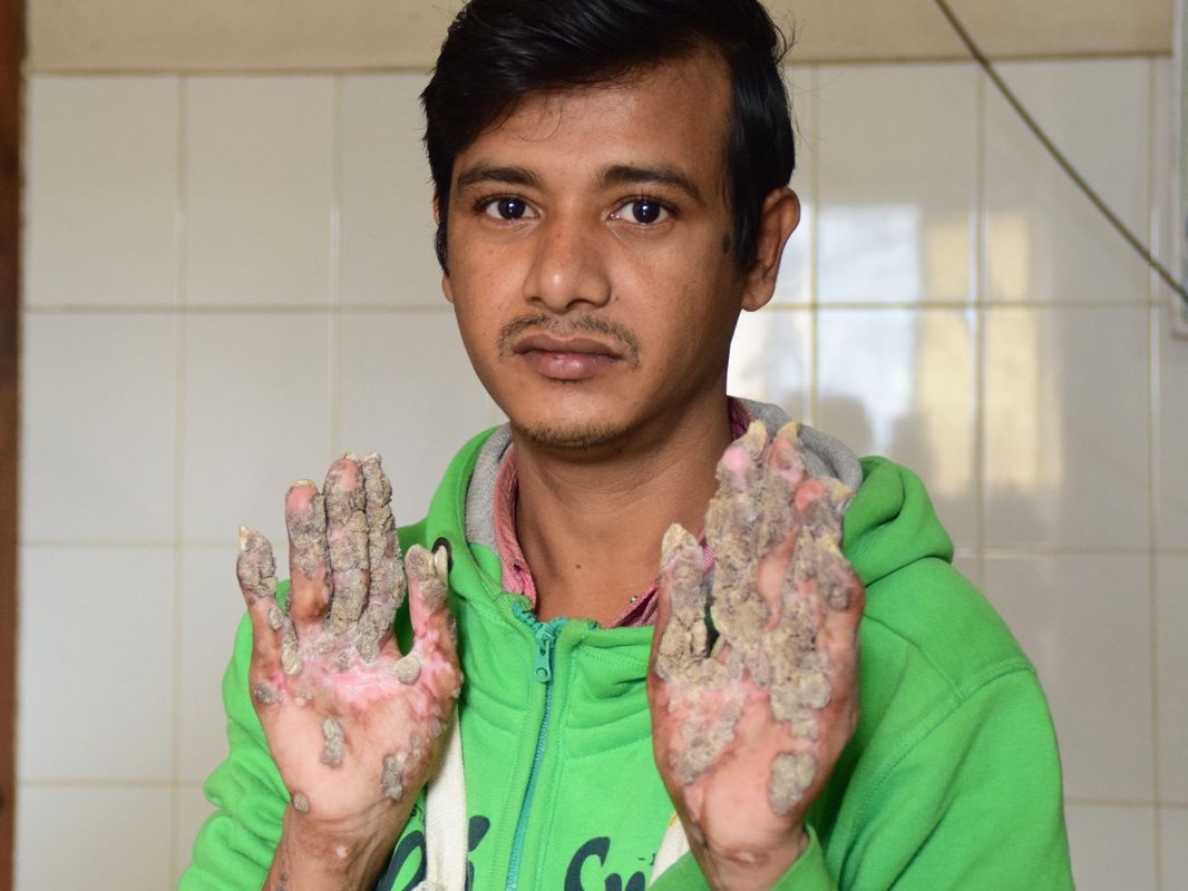 Tree Man Before And After