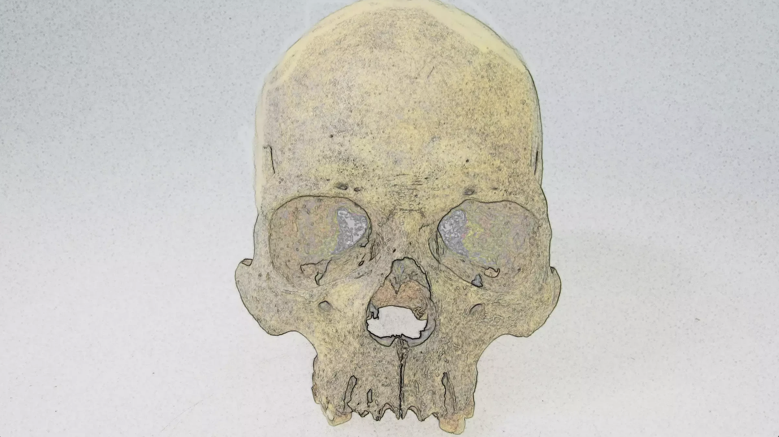 Rare form of leprosy infected people in Americas before European ...