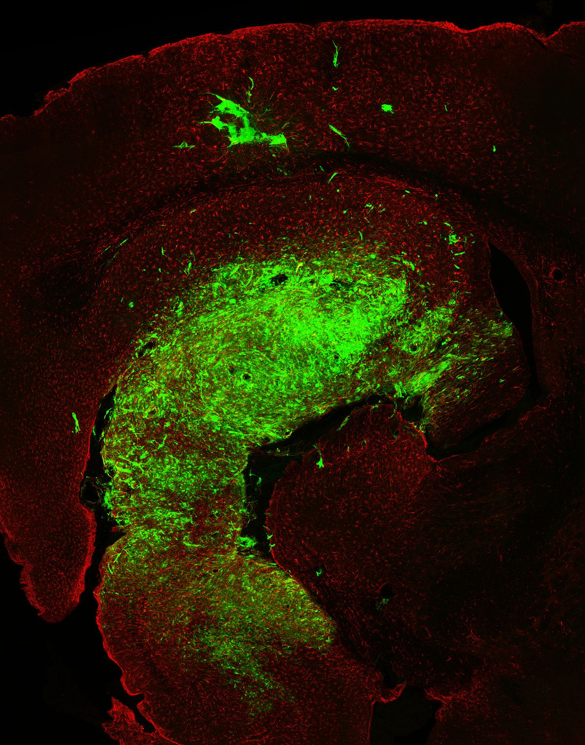 Colorful But Deadly: Images of Brain Cancer | Live Science