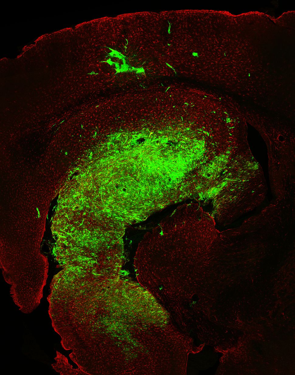 Colorful But Deadly: Images of Brain Cancer | Live Science