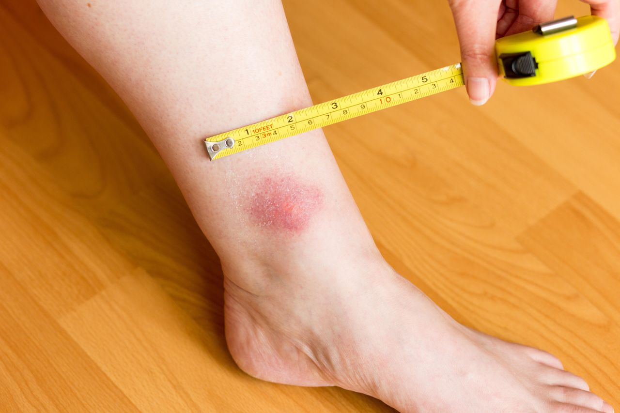 What are the different types of insect bites? | GoodtoKnow