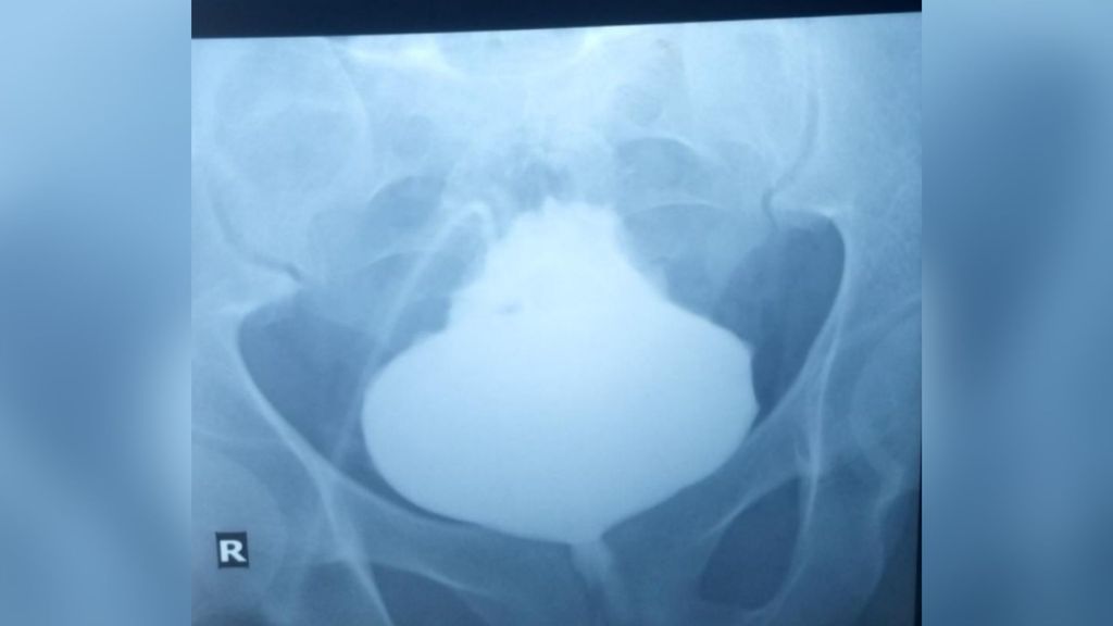 Diagnostic dilemma: A man's bladder looked like a Christmas tree | Live ...