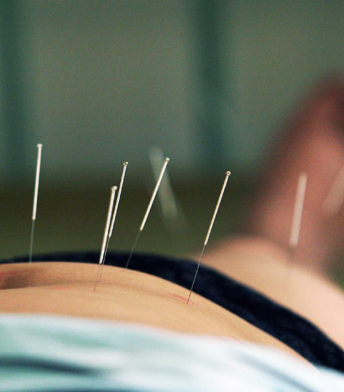 I Tried Acupuncture for Bloating | Who What Wear