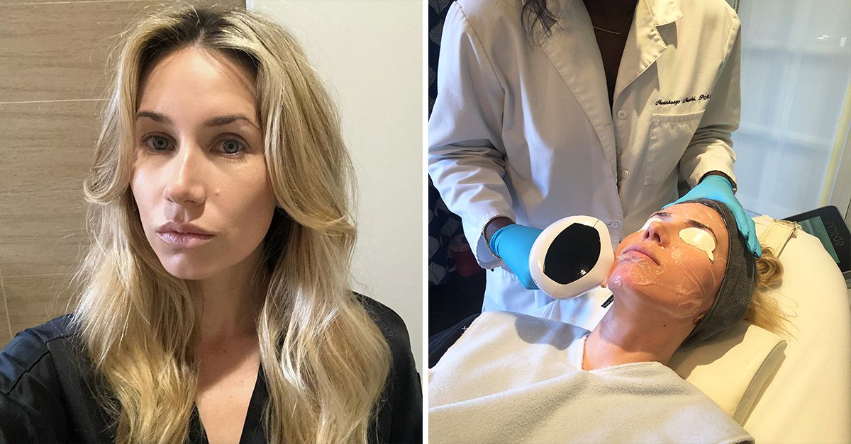 Everything You Need to Know About IPL Treatments | Who What Wear