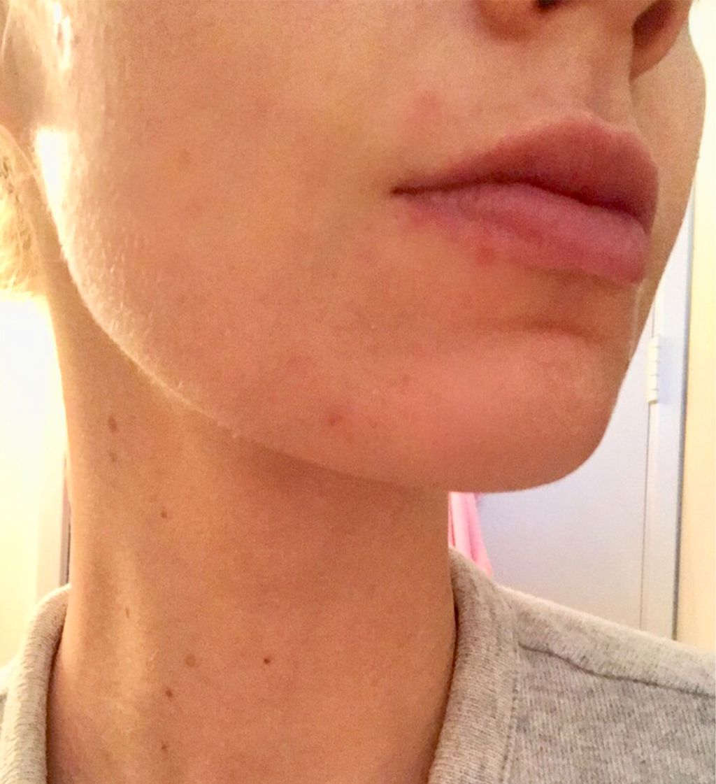 3 Overnight Acne Treatments That Actually Work | Who What Wear