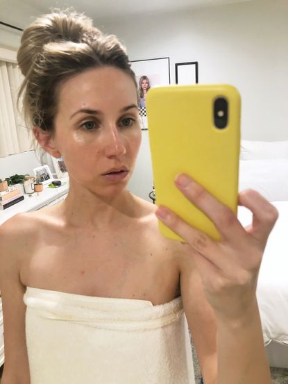 Everything You Need to Know About Micro-Needling | Who What Wear