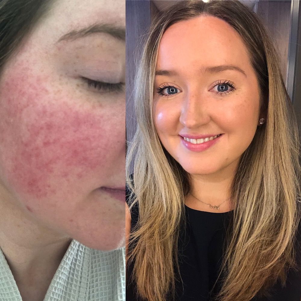 I Recommend These Products for Rosacea More Than Any Others | Who What Wear