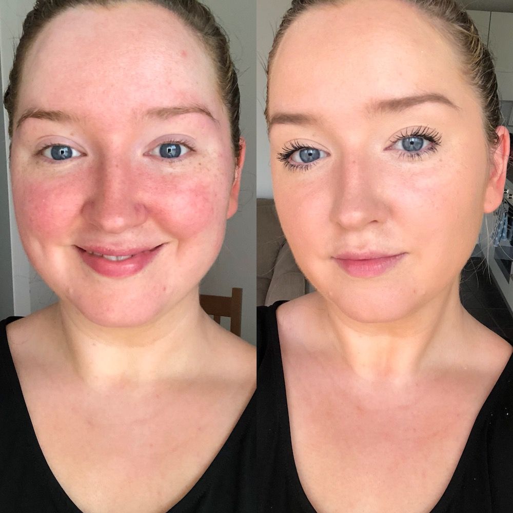 These Are the 17 Best Products for Rosacea, Hands Down | Who What Wear UK