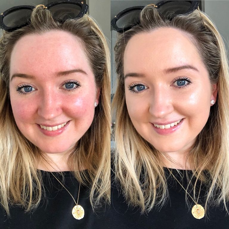These Are the 17 Best Products for Rosacea, Hands Down | Who What Wear UK