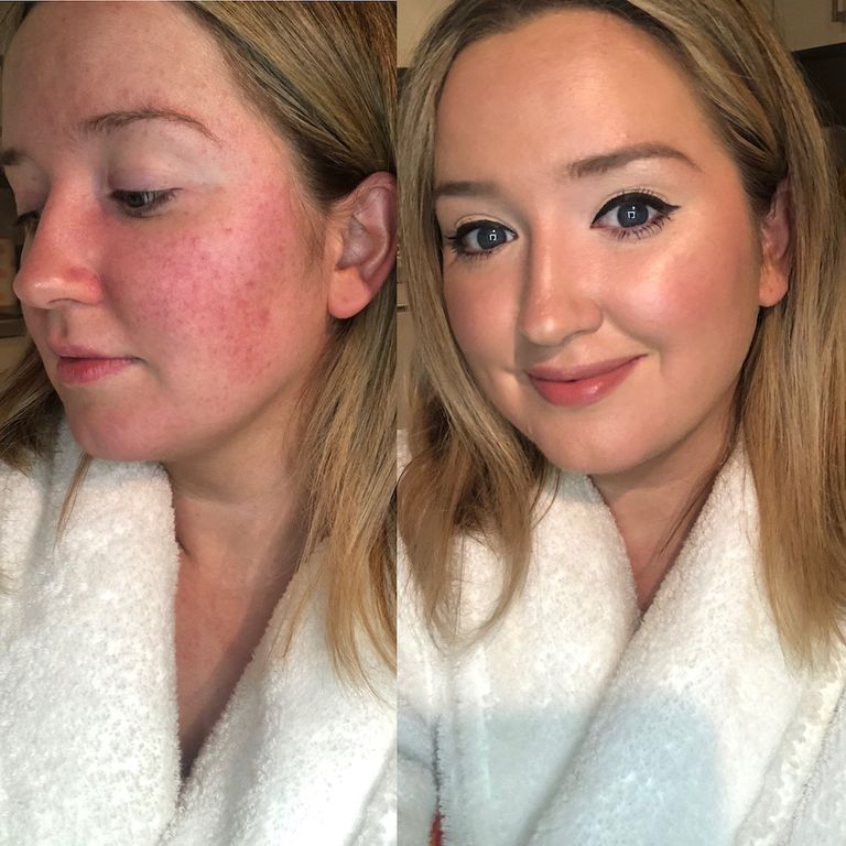 I Recommend These Products for Rosacea More Than Any Others | Who What Wear