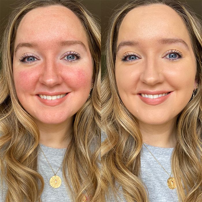 These Are the 17 Best Products for Rosacea, Hands Down | Who What Wear UK