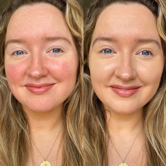 These Are the 17 Best Products for Rosacea, Hands Down | Who What Wear UK