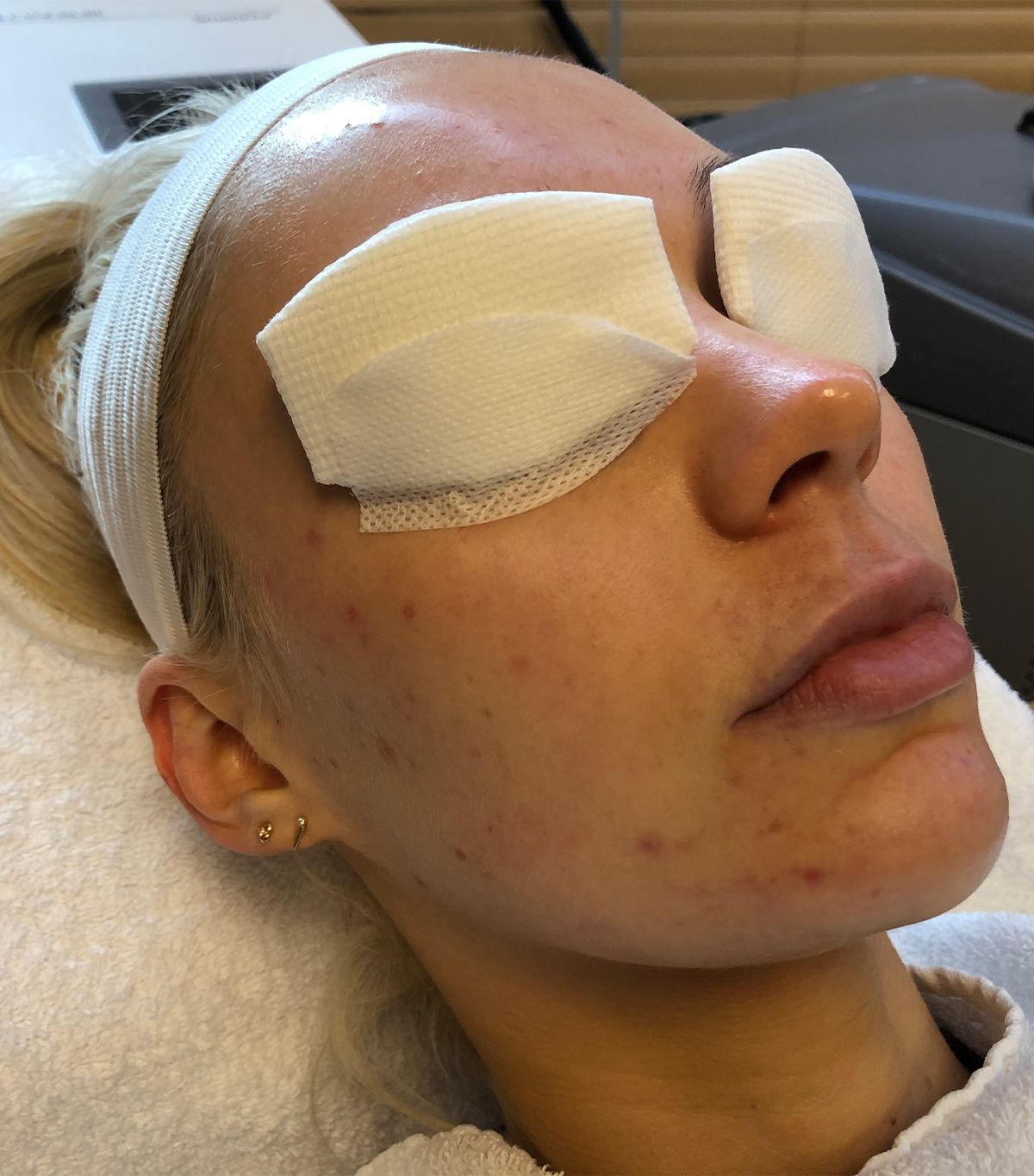 An Honest Review of Sebacia, the Acne-Clearing Treatment | Who What Wear