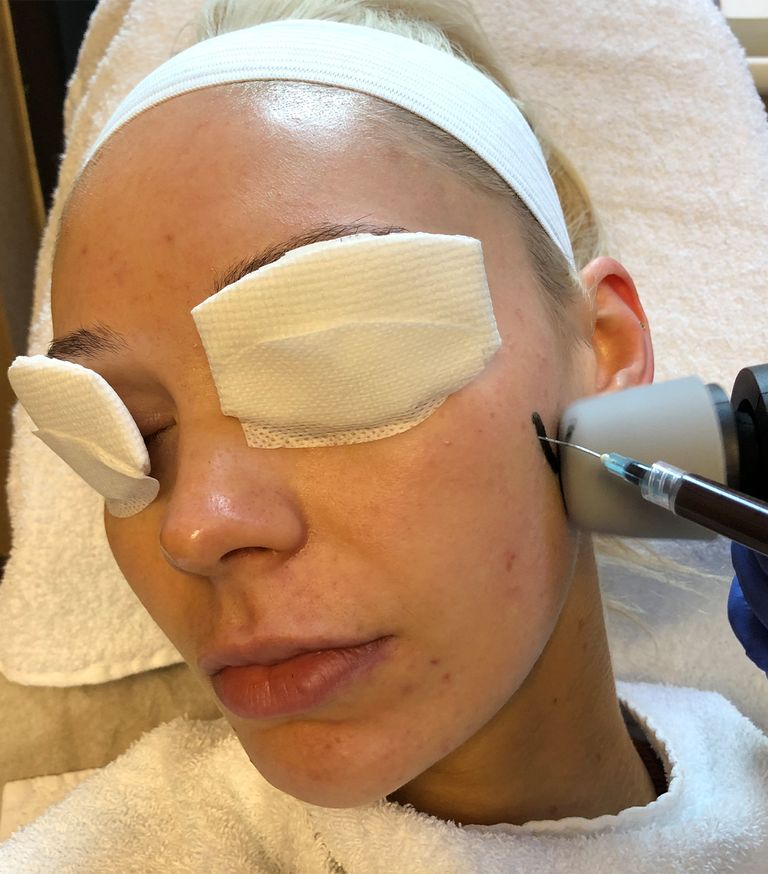 An Honest Review of Sebacia, the Acne-Clearing Treatment | Who What Wear