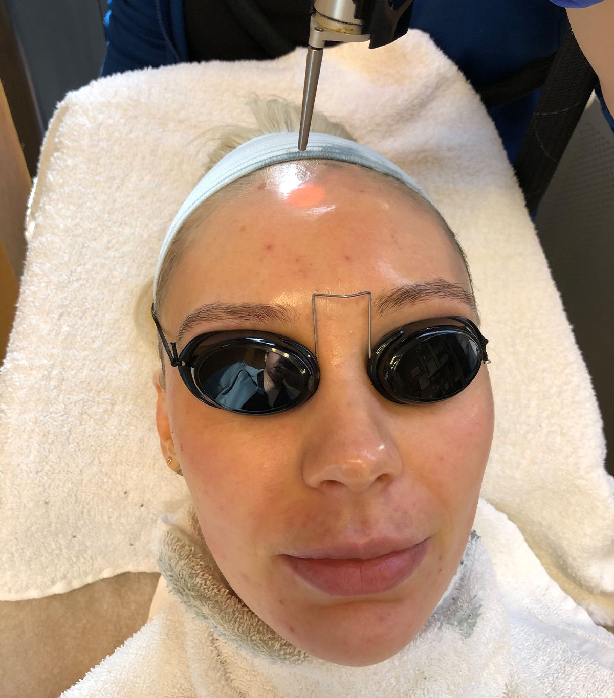 An Honest Review of Sebacia, the Acne-Clearing Treatment | Who What Wear