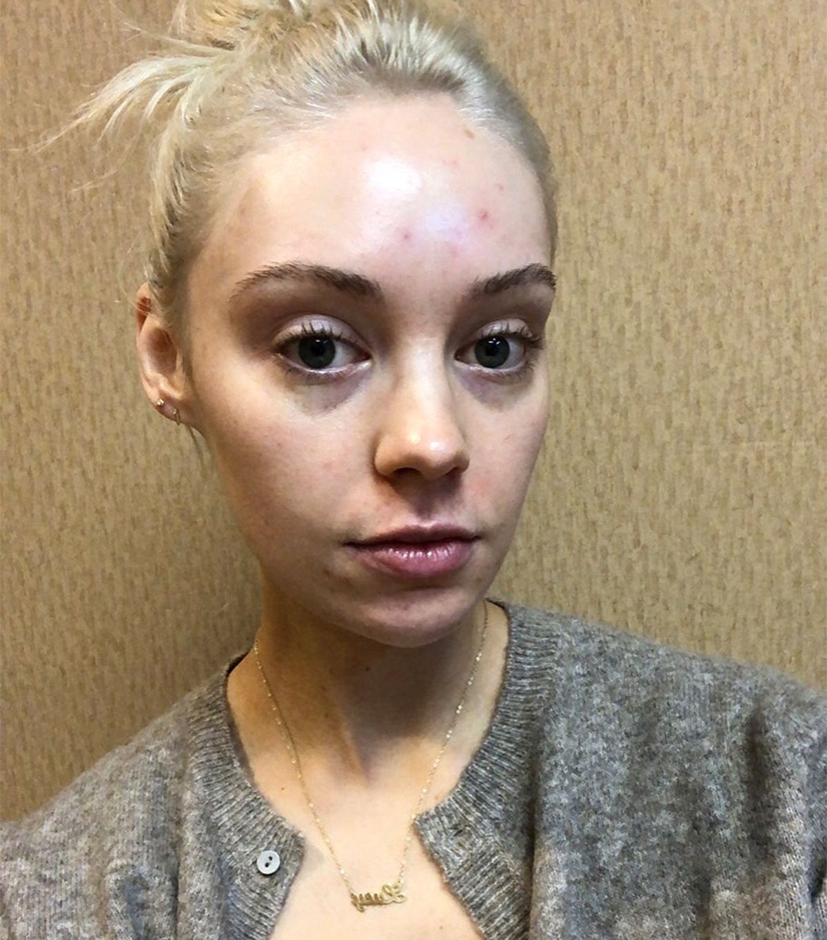 An Honest Review of Sebacia, the Acne-Clearing Treatment | Who What Wear