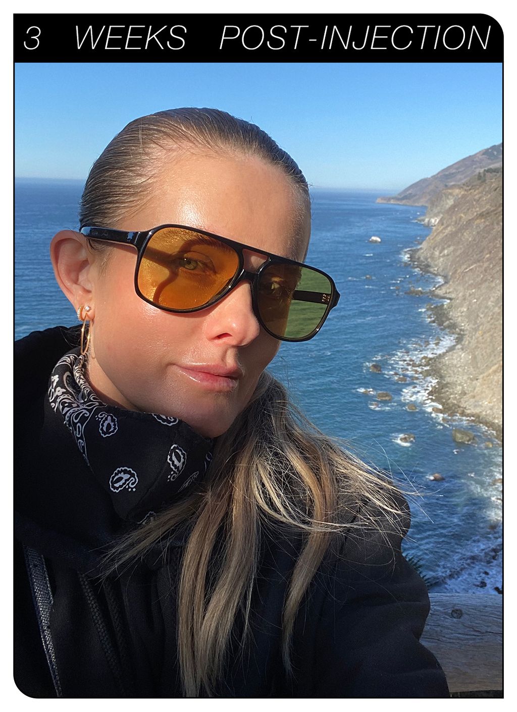 Keyhole Lip Filler: What It Is and What to Expect | Who What Wear