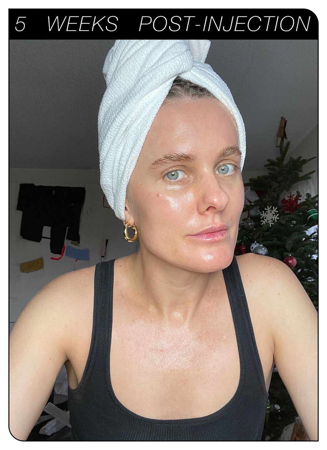 Keyhole Lip Filler: What It Is and What to Expect | Who What Wear