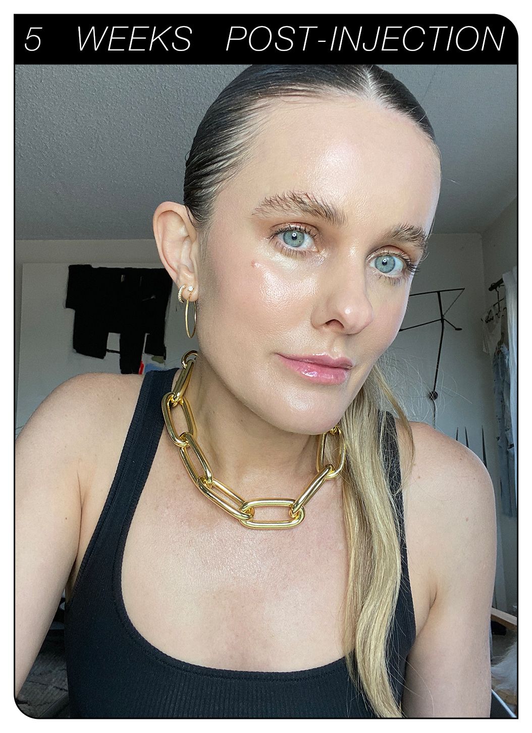 Keyhole Lip Filler: What It Is and What to Expect | Who What Wear